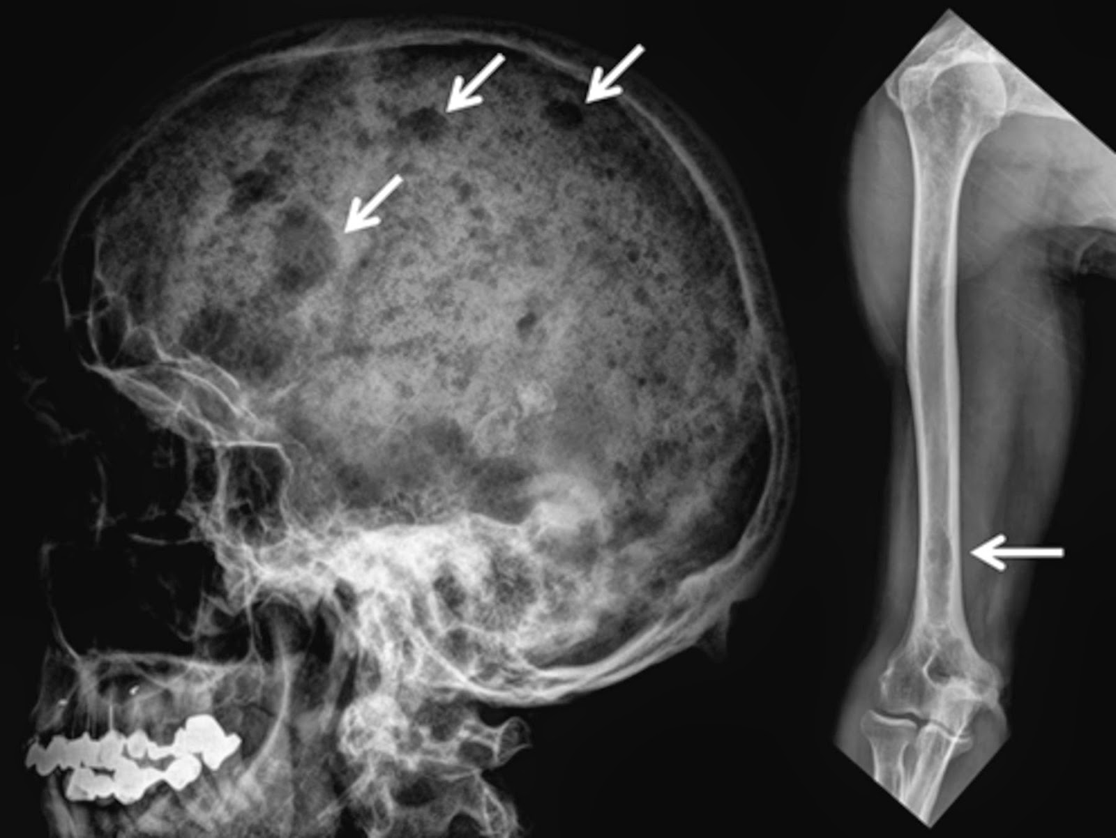 30 Martie – Ziua Internațională de luptă împotriva Mielomului Multiplu ...